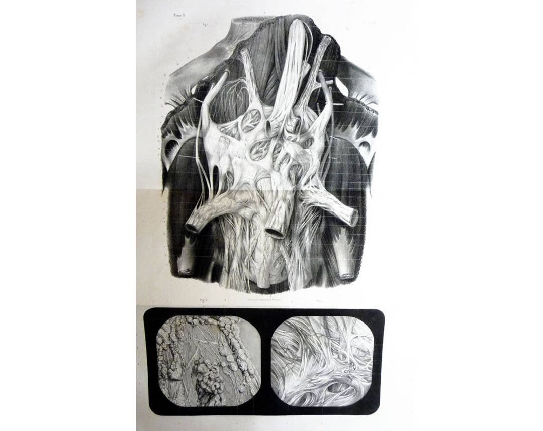 1844 Antique XL Solar Plexus Anatomy Lithograph Nervous System Human ...