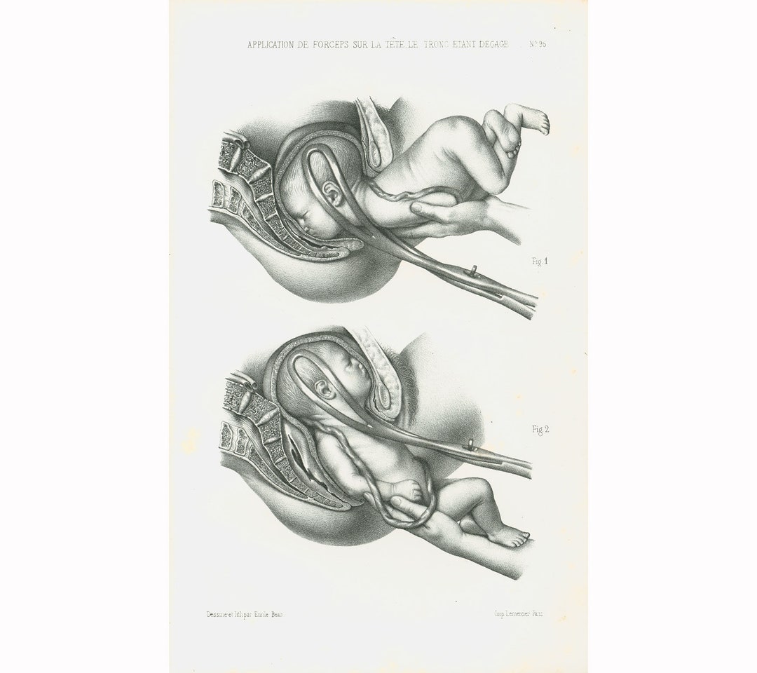 1865 Childbith Obstetrical Forceps, Human Fetus, Antique Obstetrics ...