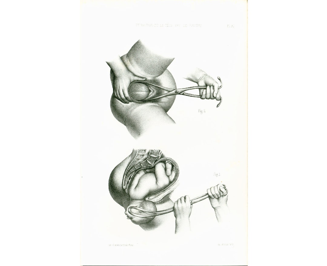 1865 Forceps Delivery, Human Fetus, Original Anatomical Chart, Poster ...