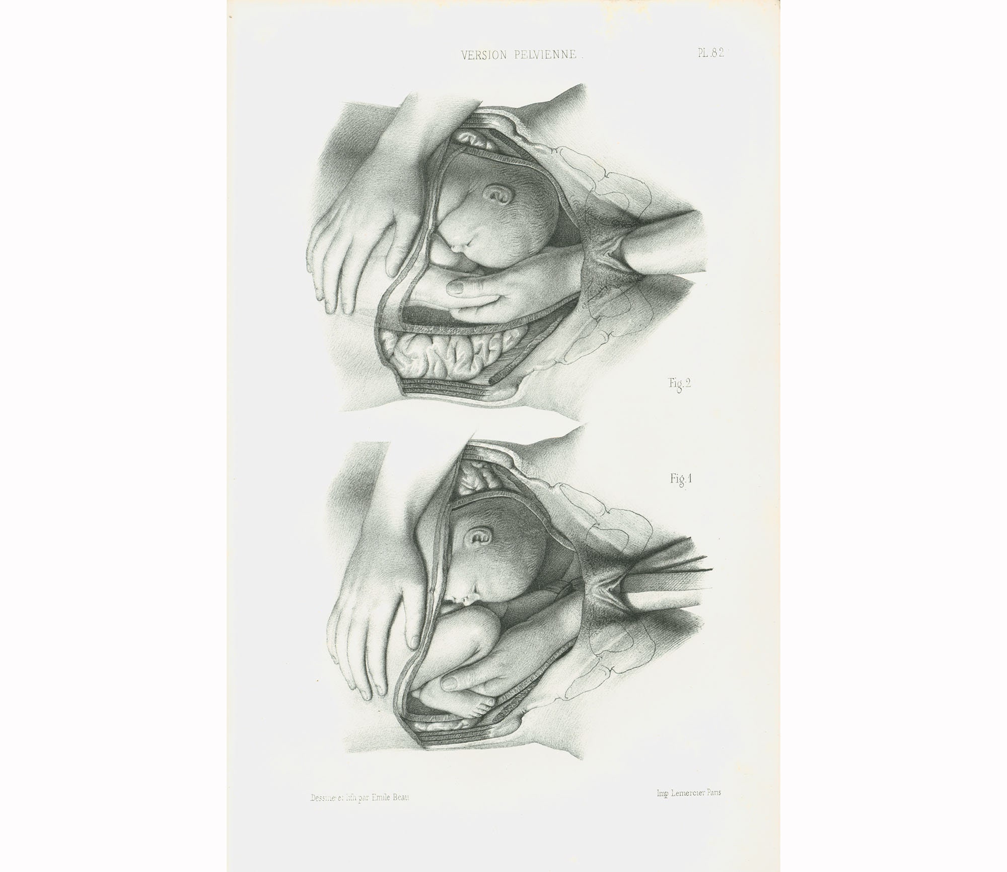 1865 Childbirth, Antique Obstetrics Print, Anatomy Embryology ...