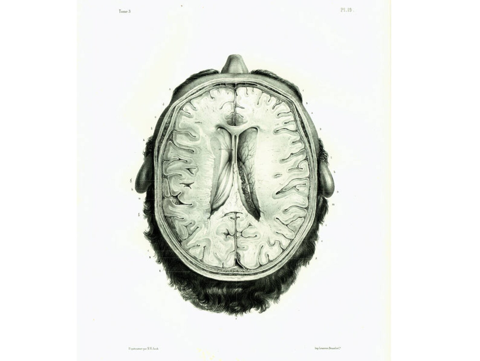 1844 XL Antique Brain Print Human Skull Brain Anatomy Poster - Etsy