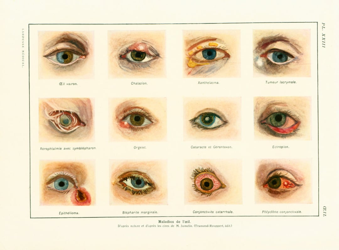 1912 Eye Anatomy, Eye Disease, Wall Eyes, Minnow, Medicine & Surgery ...