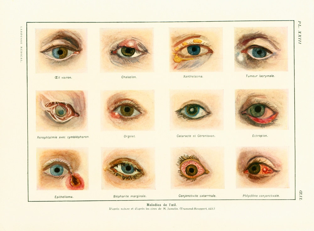 Eye Diseases Chart