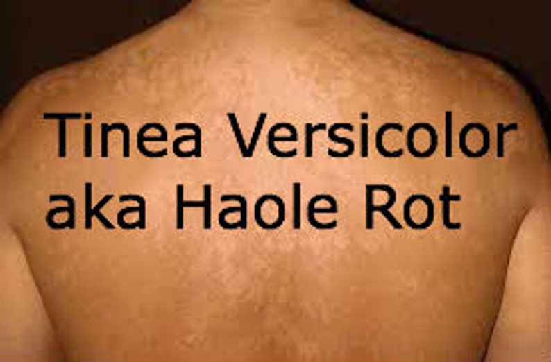 Haole Rot Spray Tinea Versicolor Treatment Natural Tinea | Etsy