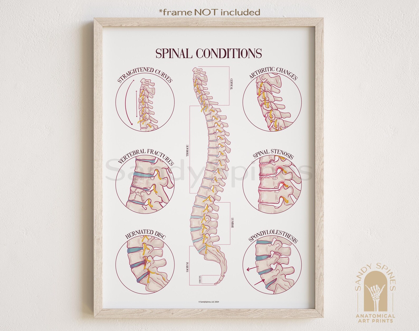 Spinal Conditions and Injury Poster | SANDYSPINES | Art for ...