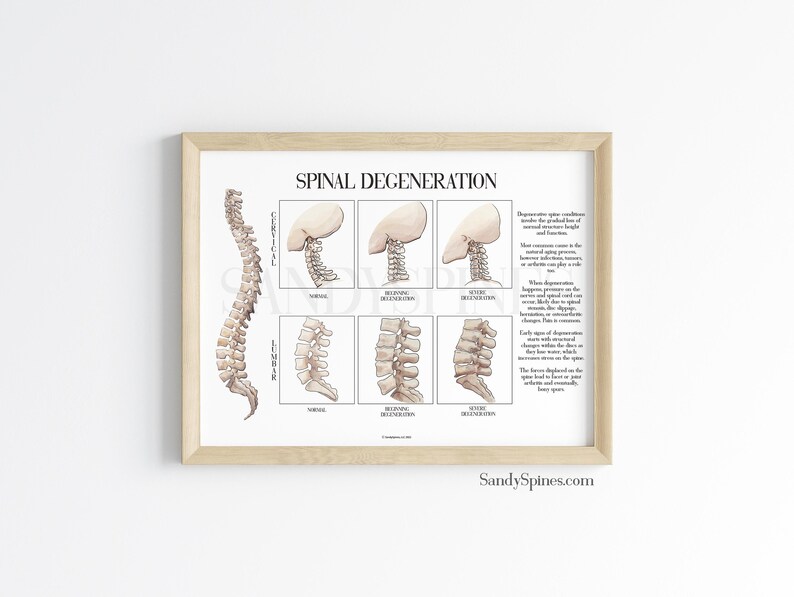 Spinal Degeneration Poster SANDYSPINES Art for - Etsy