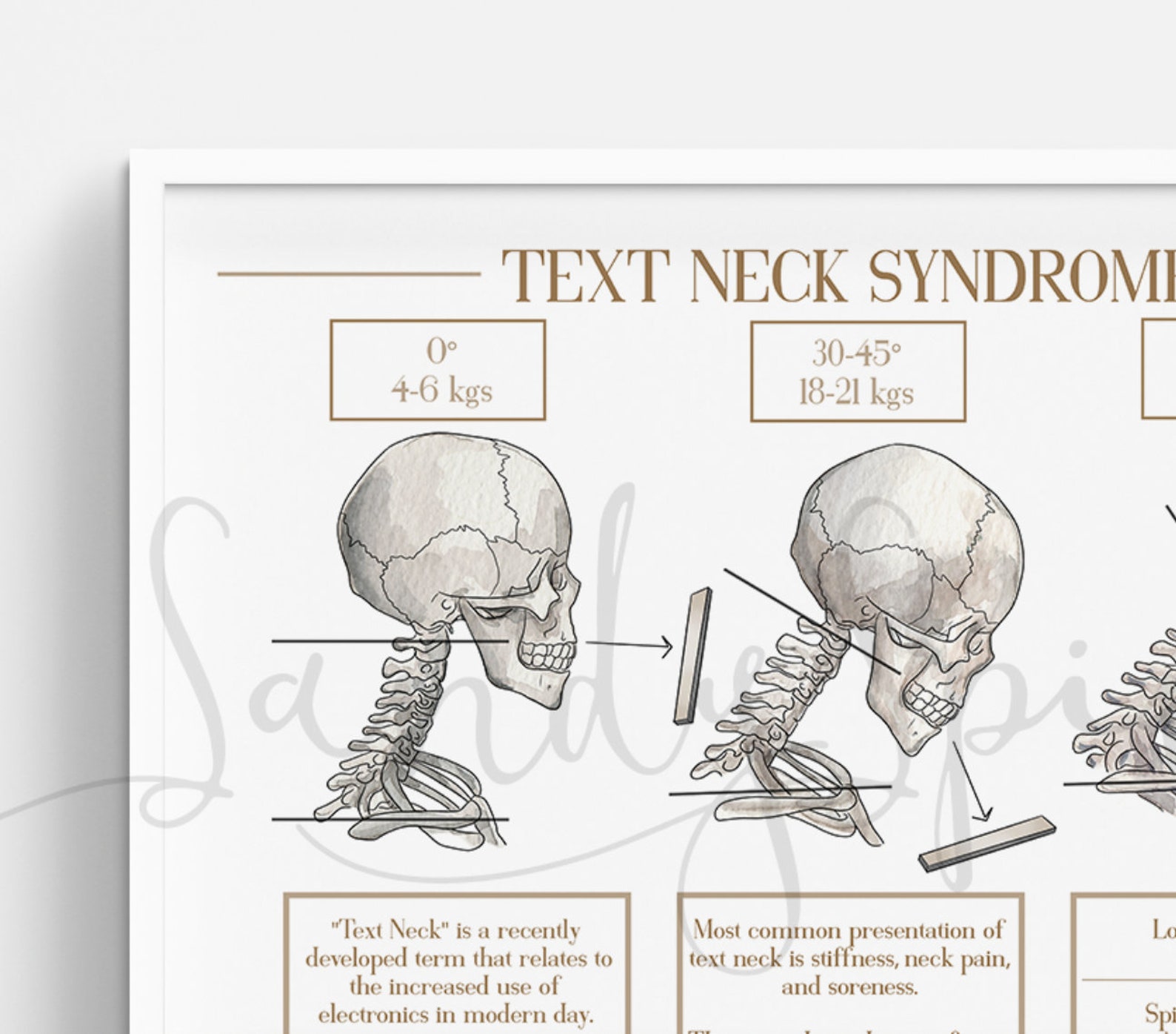 Text Neck Syndrome Poster SANDYSPINES Art for Medical - Etsy