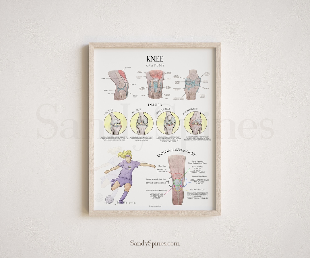 Knee Anatomy and Injury Poster | Sandyspines | Art for Chiropractors ...