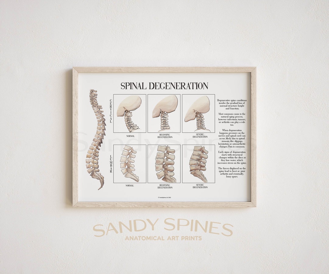 Spinal Degeneration Poster | SANDYSPINES | Art for Chiropractors ...