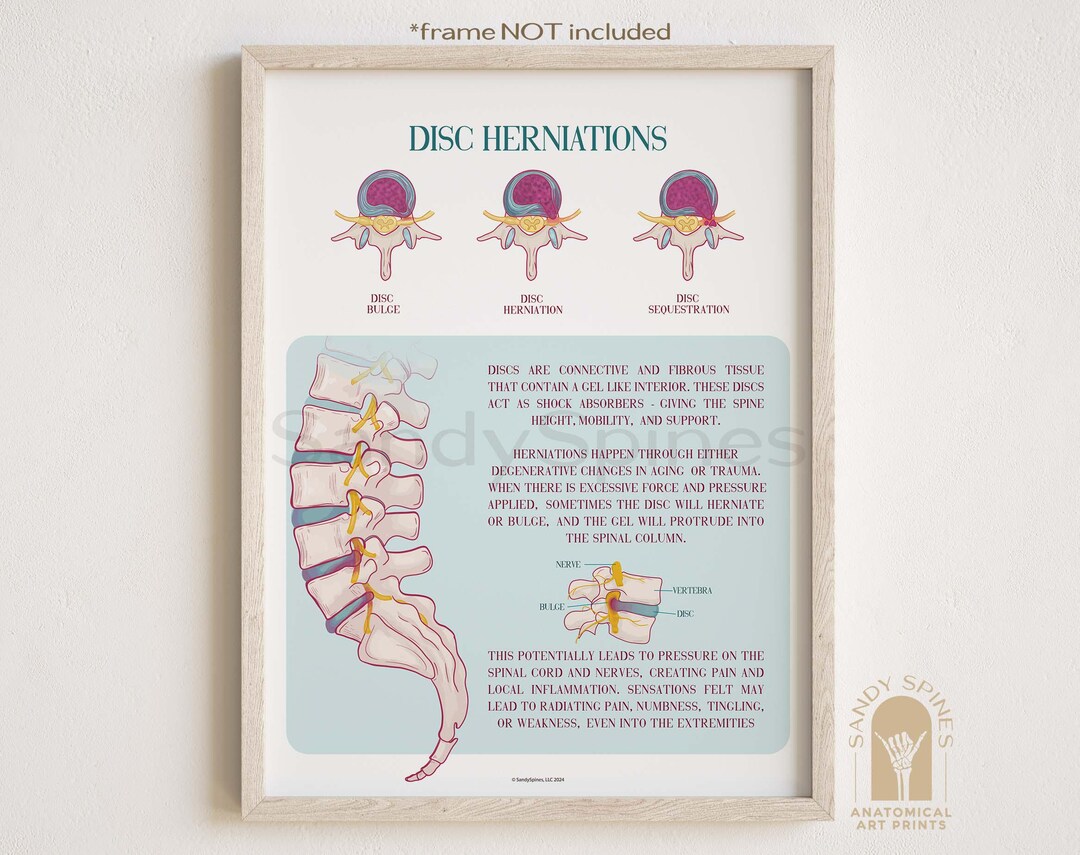 Disc Herniation Injury Poster by Sandyspines | Chiropractic Physical ...