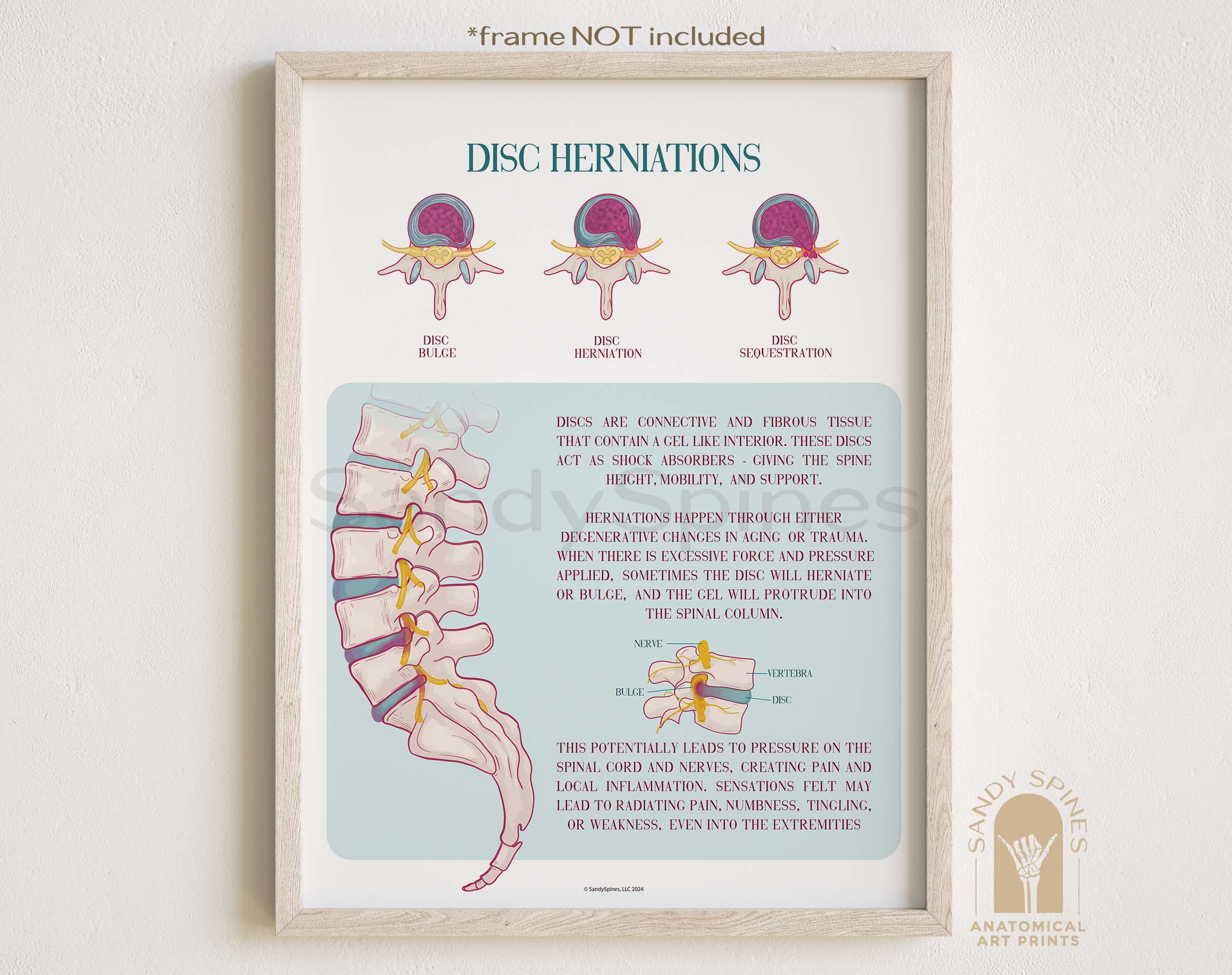 Disc Herniation Injury Poster by Sandyspines | Chiropractic Physical ...