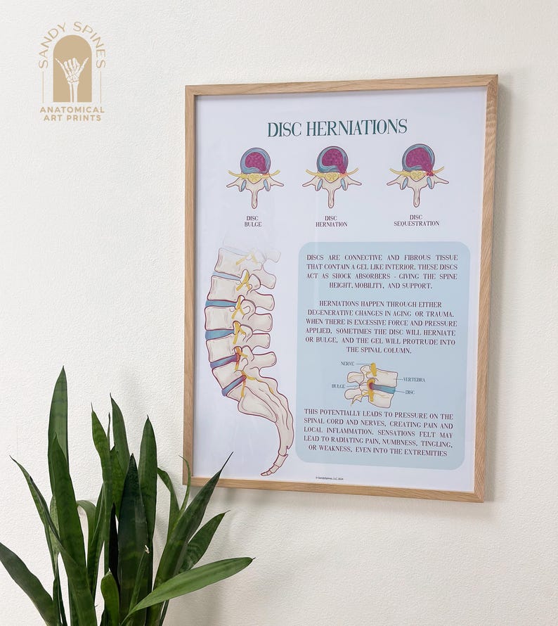 Disc Herniation Injury Poster by Sandyspines | Chiropractic Physical ...