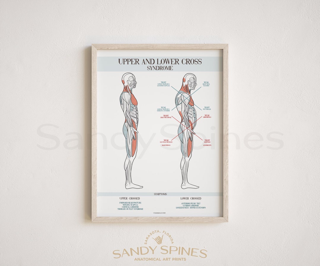 Upper and Lower Cross Syndrome Poster | SANDYSPINES | Art for ...