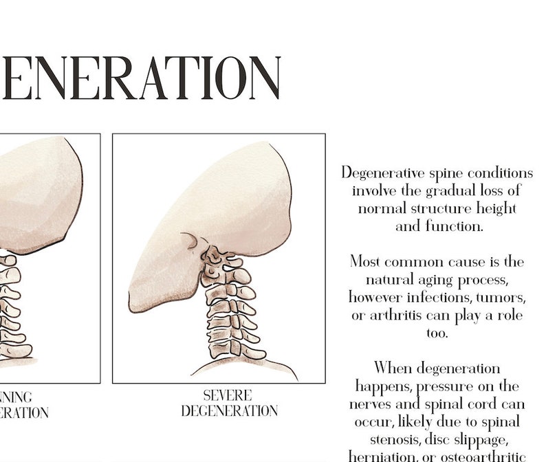 Spinal Degeneration Poster SANDYSPINES Art for - Etsy