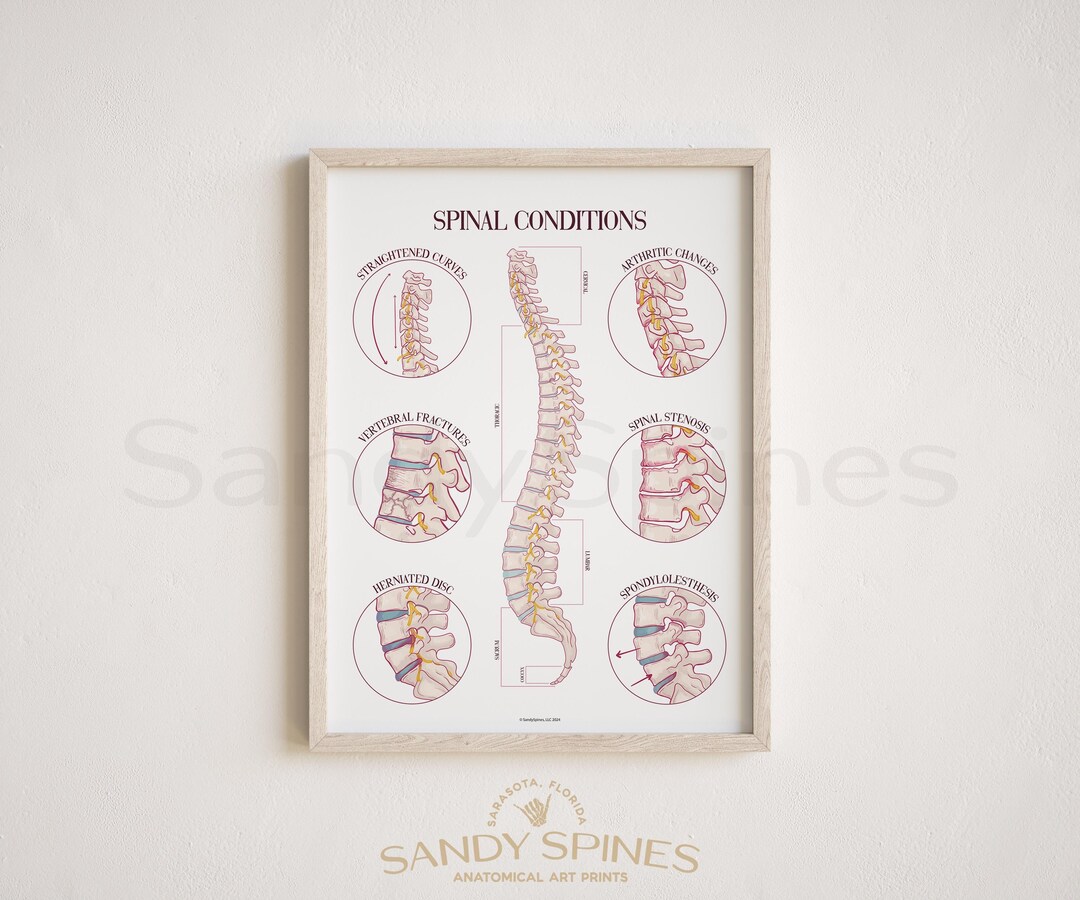 Spinal Conditions and Injury Poster | SANDYSPINES | Art for ...