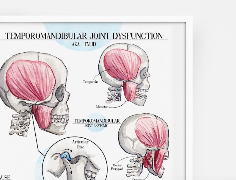 TMJD Poster SANDYSPINES Temporomandibular Joint Dysfunction | Etsy
