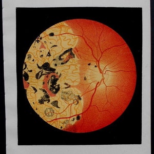 1854 Set of 8 Color Lithographs: Eye Anatomy Under an Opthalmoscope ...