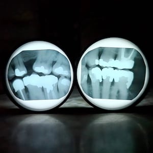 X-ray Plugs, Dental X-ray, X-ray, Dental, Resin Plugs, Set of Plugs ...