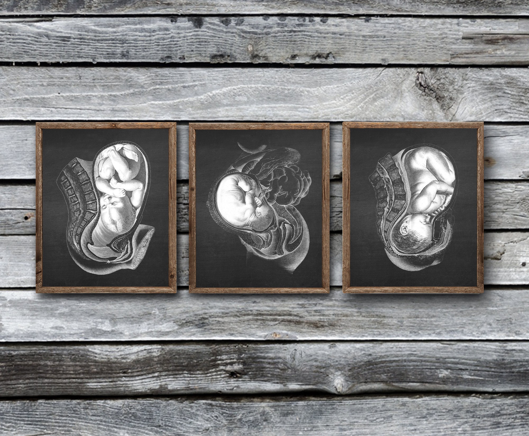 Womb Anatomy Art Prints, Set of 3, Obstetrics and Gynecology Decor - Etsy