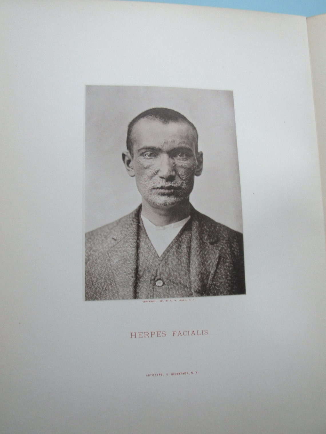 Photographic Illustrations of Skin Diseases by George Henry Fox 1887 ...