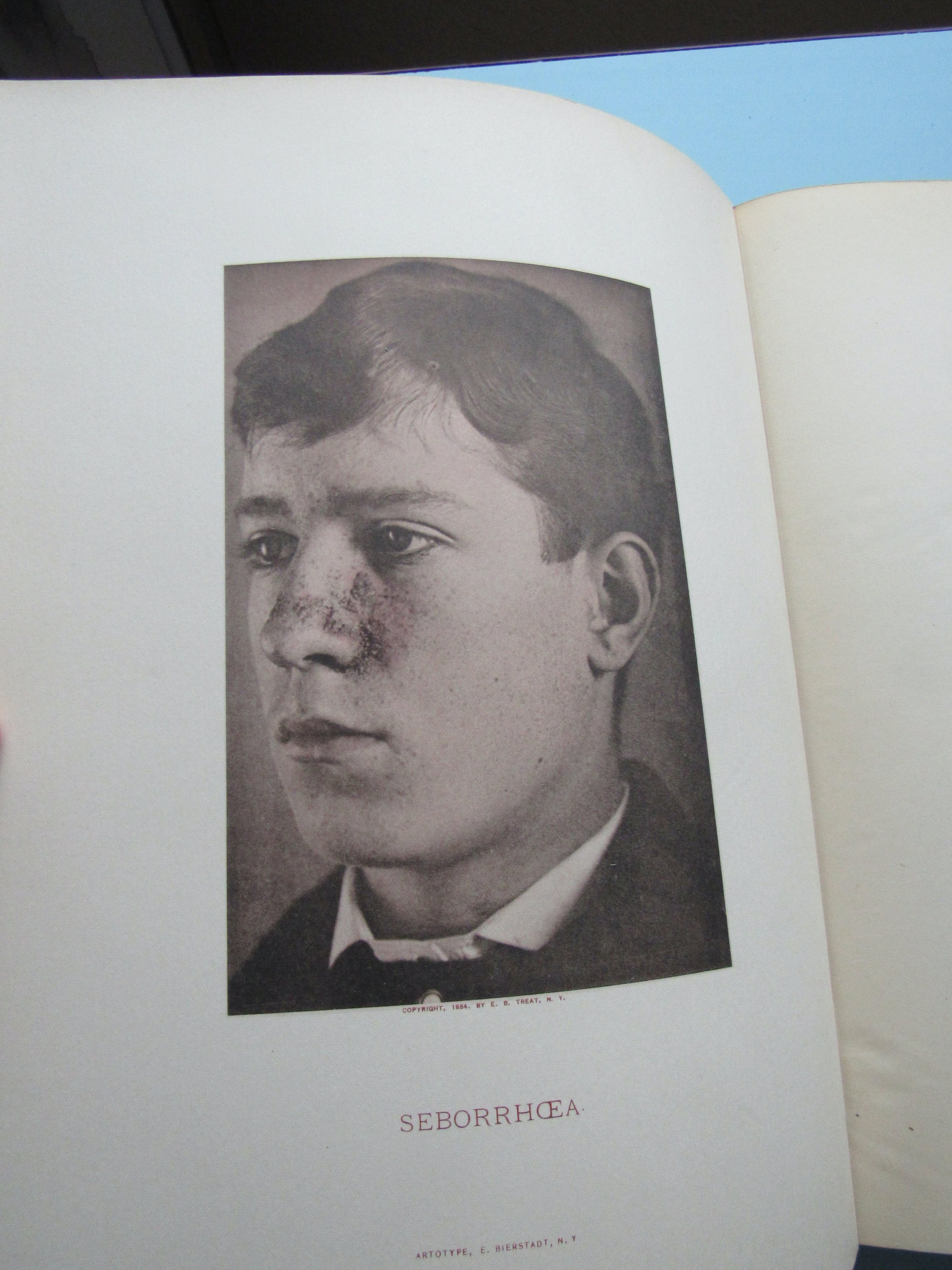 Photographic Illustrations of Skin Diseases by George Henry Fox 1887 ...