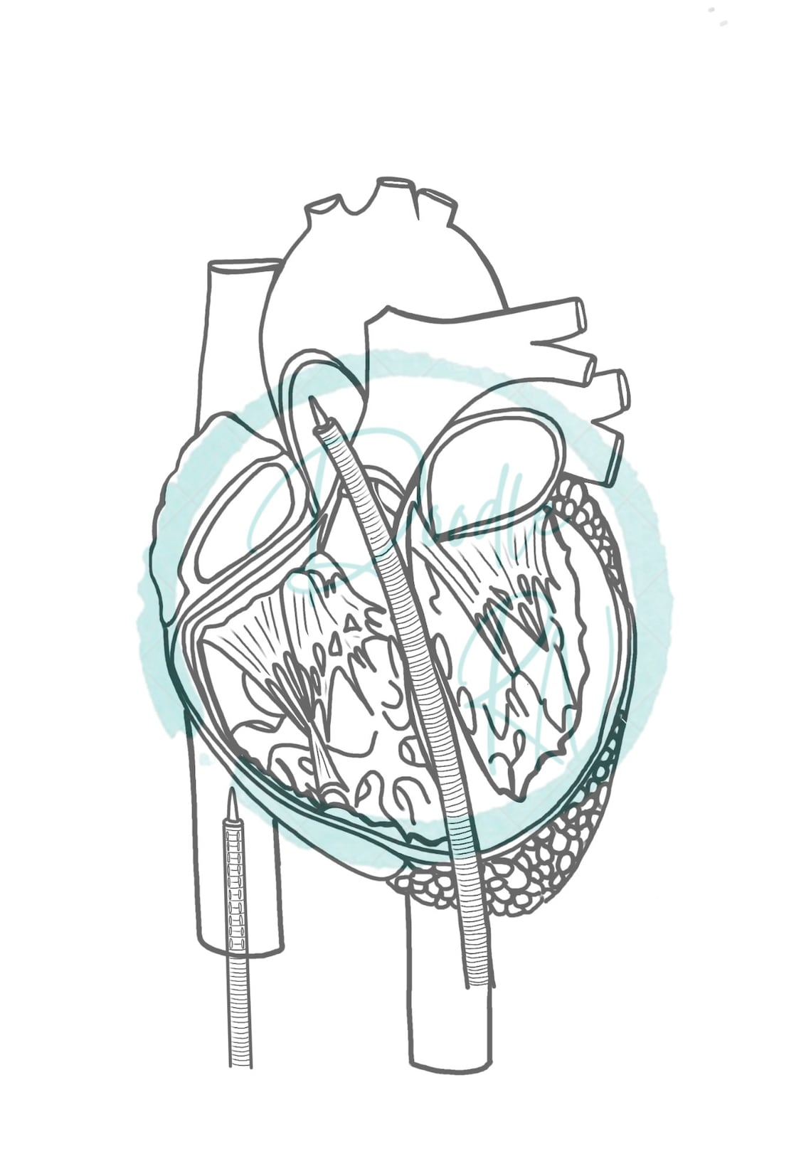 Centrally Cannulated VA ECMO Coloring Sheet;icu Nurse Coloring Sheet ...
