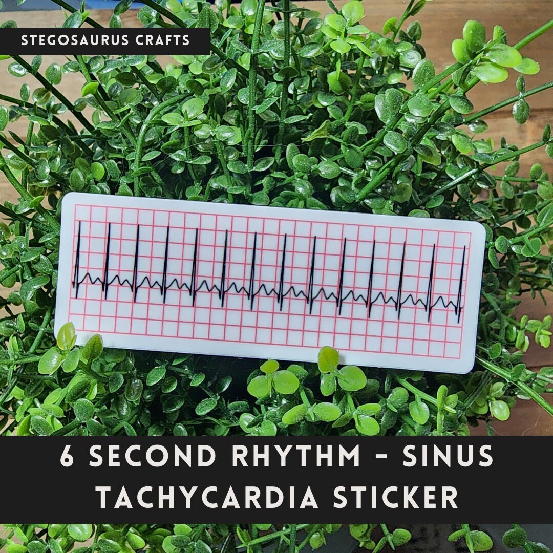 Sinus Tachycardia 6 Second Rhythm Strip (accurate) - Nursing/medical ...