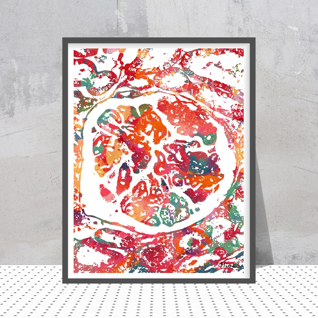 Lupus Nephritis SLE Print Anatomy Art Kidney Tissue Watercolor Showing ...