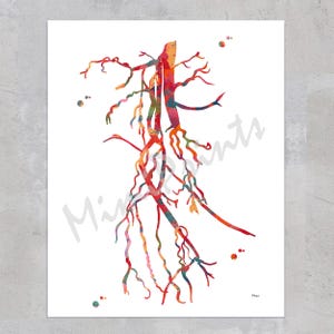 Angiography Watercolor Femoral Artery Occlusion Abstract Anatomy Print ...