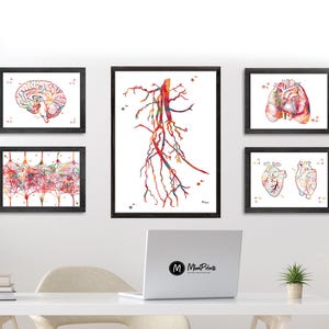 Angiography Watercolor Femoral Artery Occlusion Abstract Anatomy Print ...