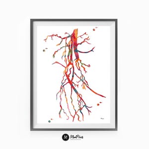 Angiography Watercolor Femoral Artery Occlusion Abstract Anatomy Print ...