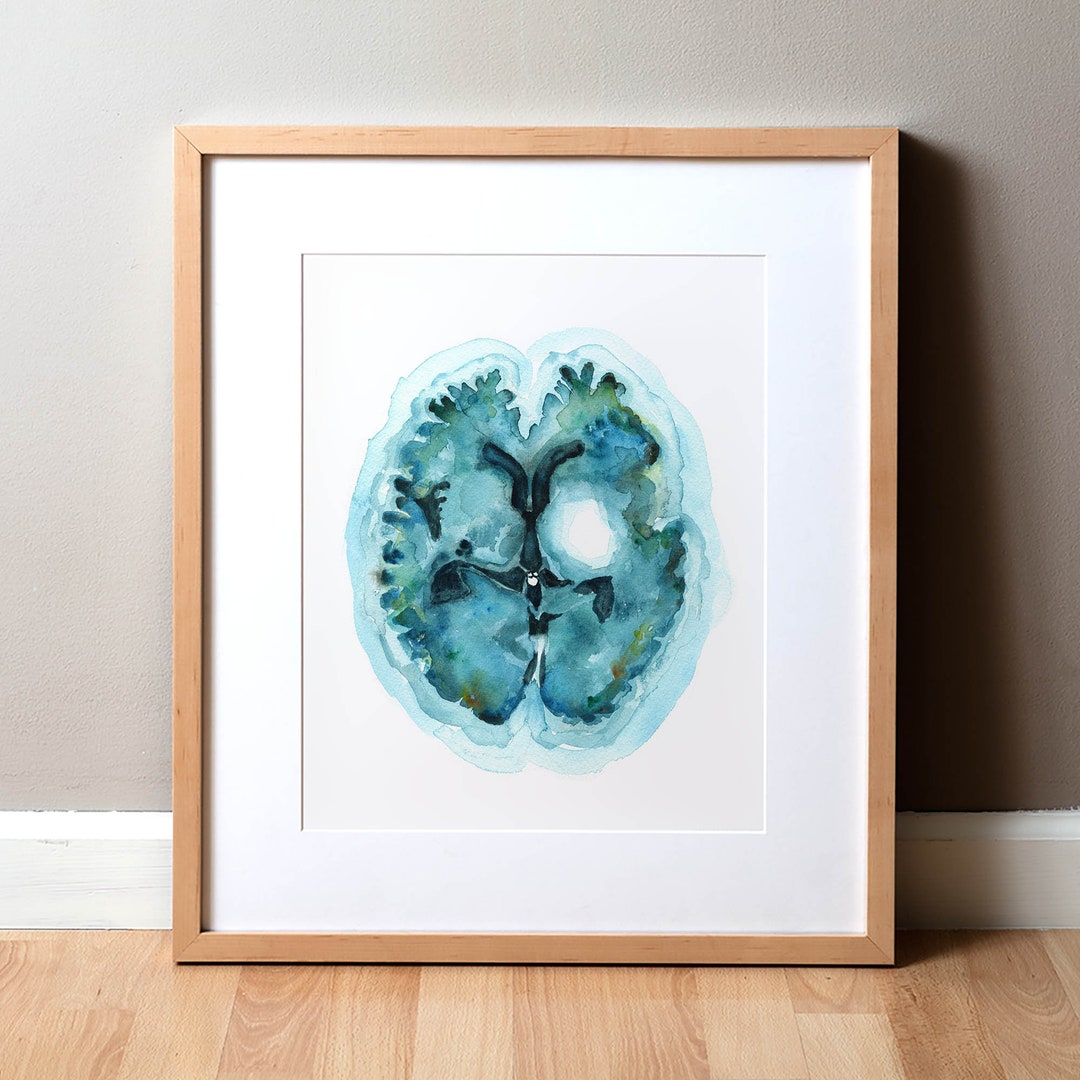 Hemorrhagic Stroke Watercolor Print - Neurology Art - Teal Painting ...