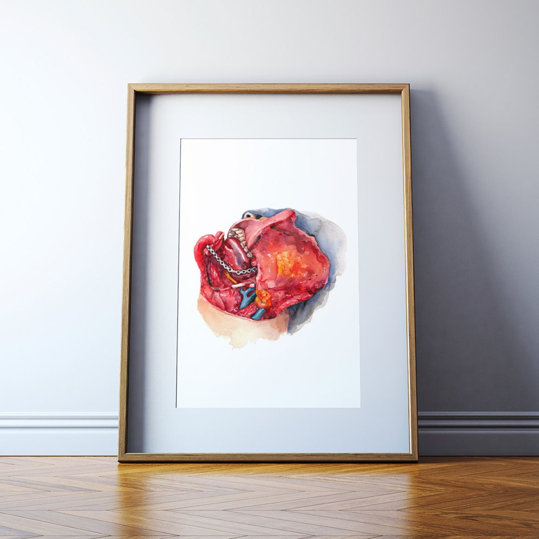 Head and Neck Dissection Watercolor Print - ENT Surgery Art Print - Etsy