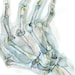 Rheumatoid Arthritis(ra) of the Hand Watercolor Print - Carpal ...