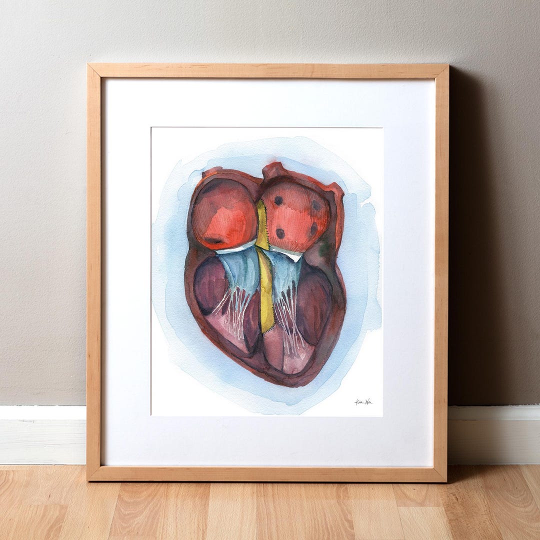 AVSD Heart Watercolor Print - Cardiology Painting - Down Syndrome Art - Pediatric Heart Defect ...