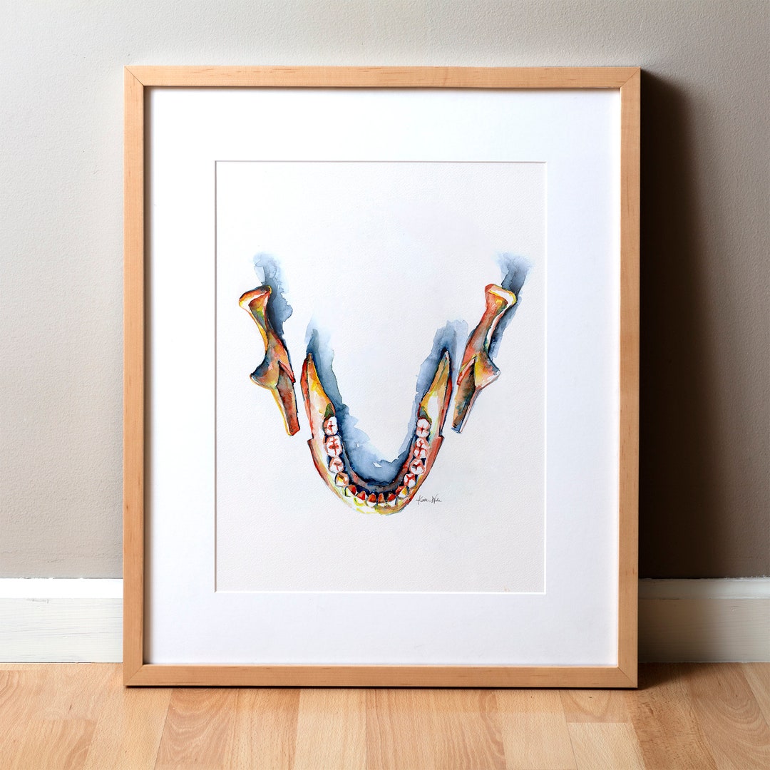 BSSO Watercolor Art Print - Mandible Surgery Abstract Anatomy Art ...