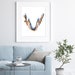 BSSO Watercolor Art Print - Mandible Surgery Abstract Anatomy Art ...