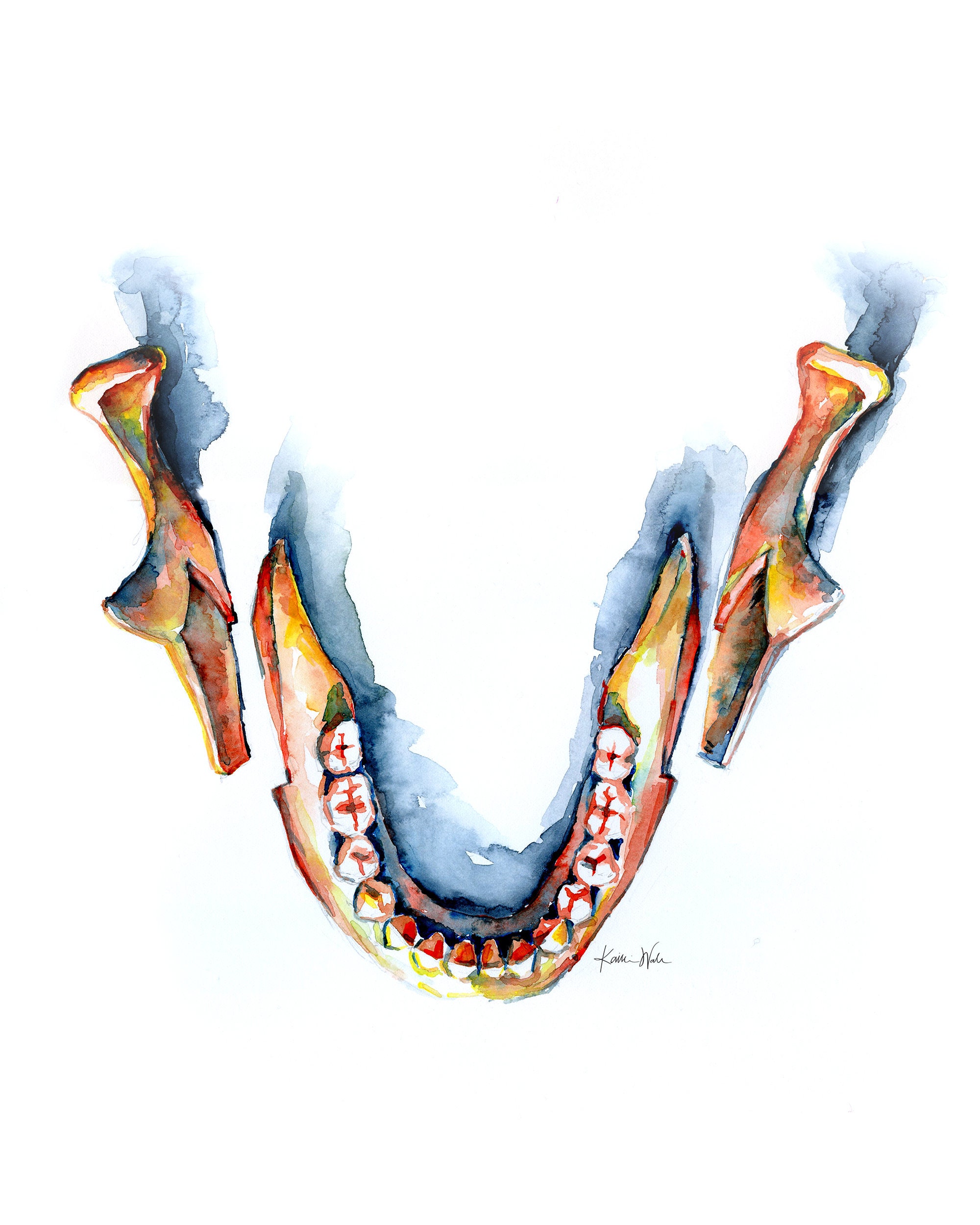 BSSO Watercolor Art Print Mandible Surgery Abstract Anatomy | Etsy
