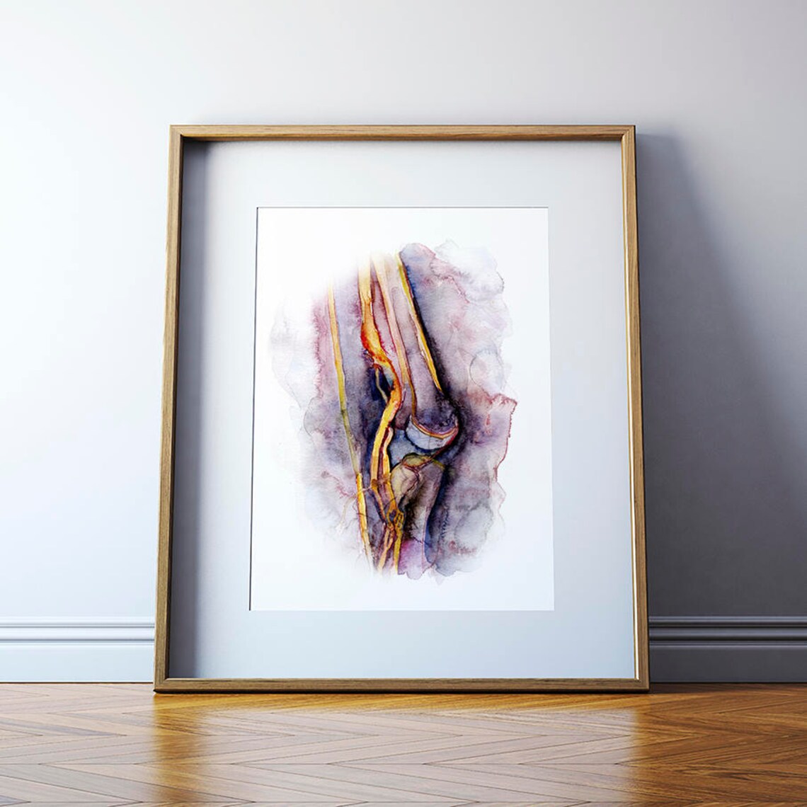 Deep Vein Thrombosis Watercolor Art Print - Cardiovascular Watercolor ...
