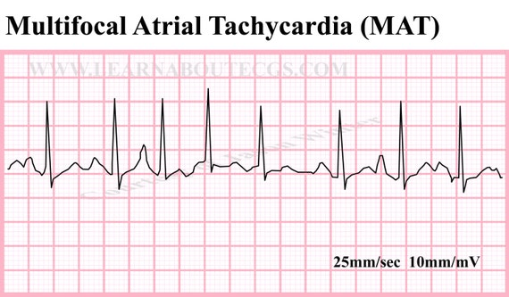 Artículos similares a Multifocal Atrial Tachycardia (MAT) ECG Strip en Etsy