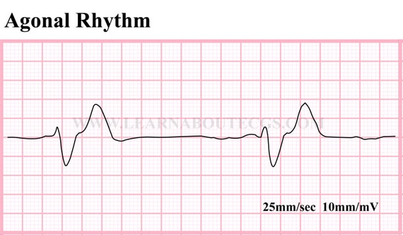 Items similar to Agonal Rhythm ECG Strip on Etsy