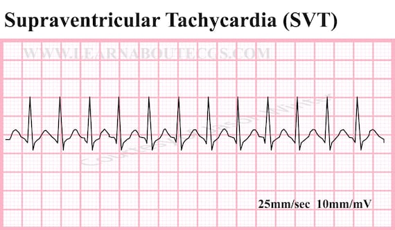 Items similar to Supraventricular Tachycardia (SVT) ECG Rhythm Strip on ...