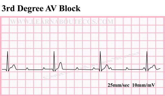 Articles similaires à 3e degré bloc AV ECG rythme Strip sur Etsy