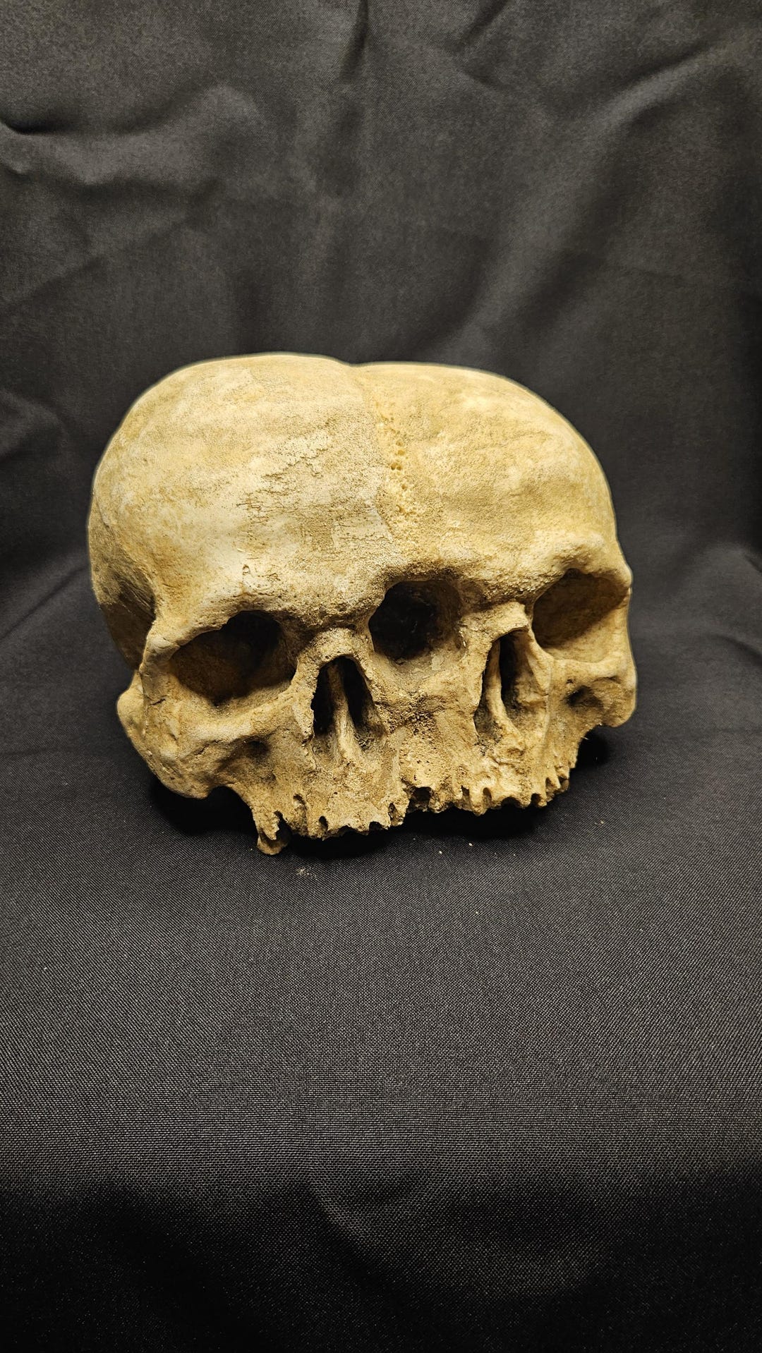 Artificial Human Skull - Moulded From Real, Human Conjoined Twins ...