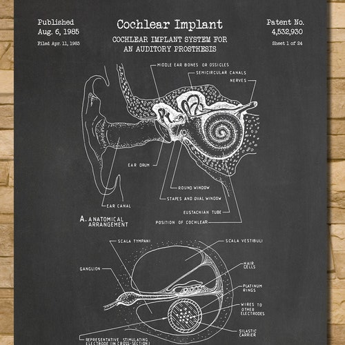 Anatomy Art Ear Implant Print Audiology Poster Cochlear - Etsy