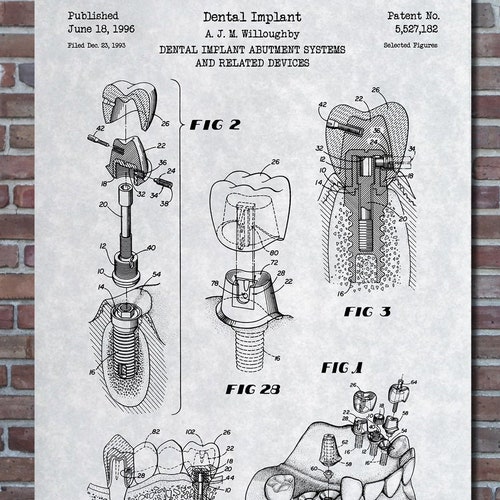 Dental Implant Patent Print Art 1996 | Etsy