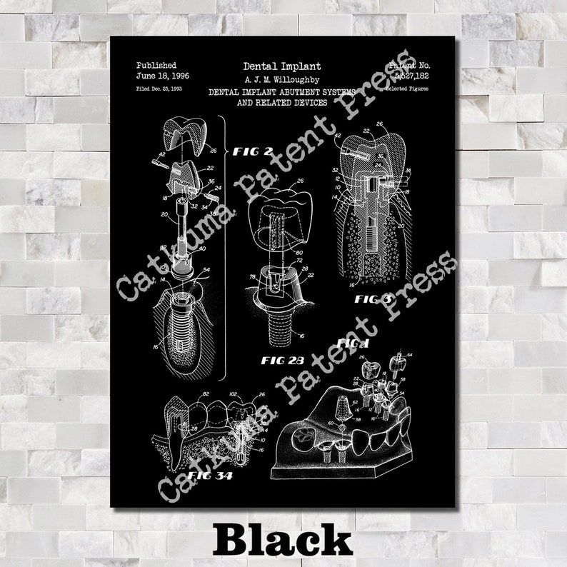 Dental Implant Patent Print Art 1996 - Etsy