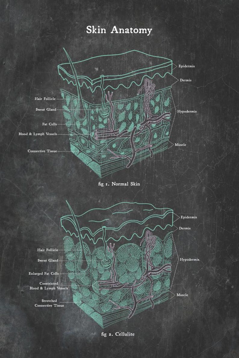 Cellulite Vs Healthy Skin Anatomy Poster: Lymphatic Drainage Art ...