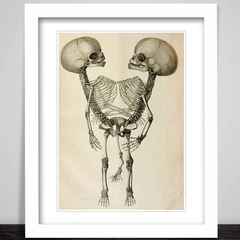 Conjoined Twins - Etsy