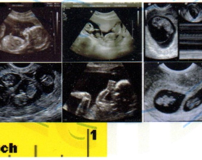 6 Miniature Doctor OBSTETRICS PREGNANCY Scans SET - Dollhouse 1/12 1/6 ...